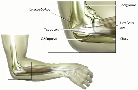 Επικονδυλίτιδα Αγκώνα - arthro-specialist.gr